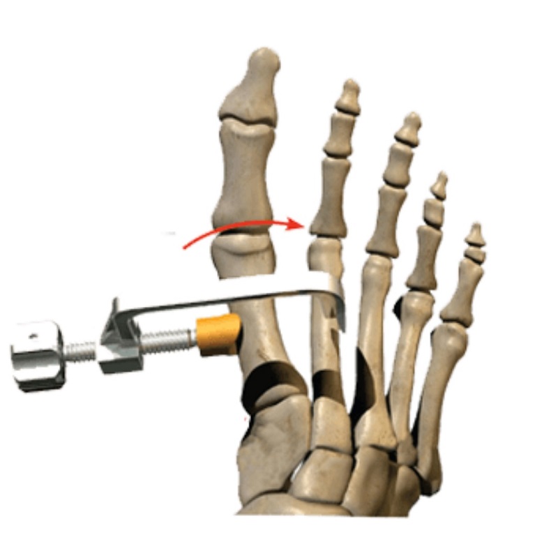 How effective is Lapiplasty® for bunion correction?