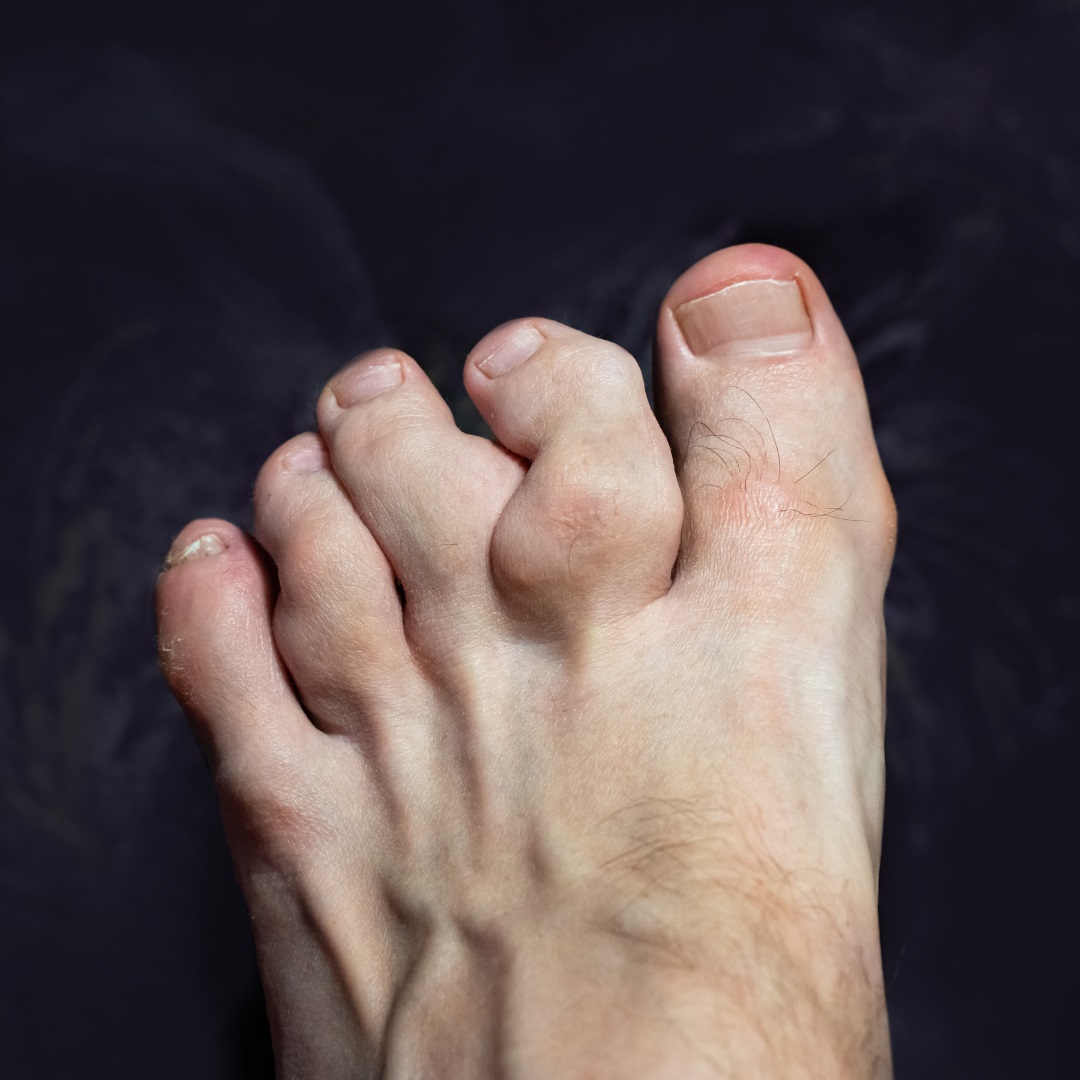 Overlapping Toes Correction: Restore Comfort and Alignment